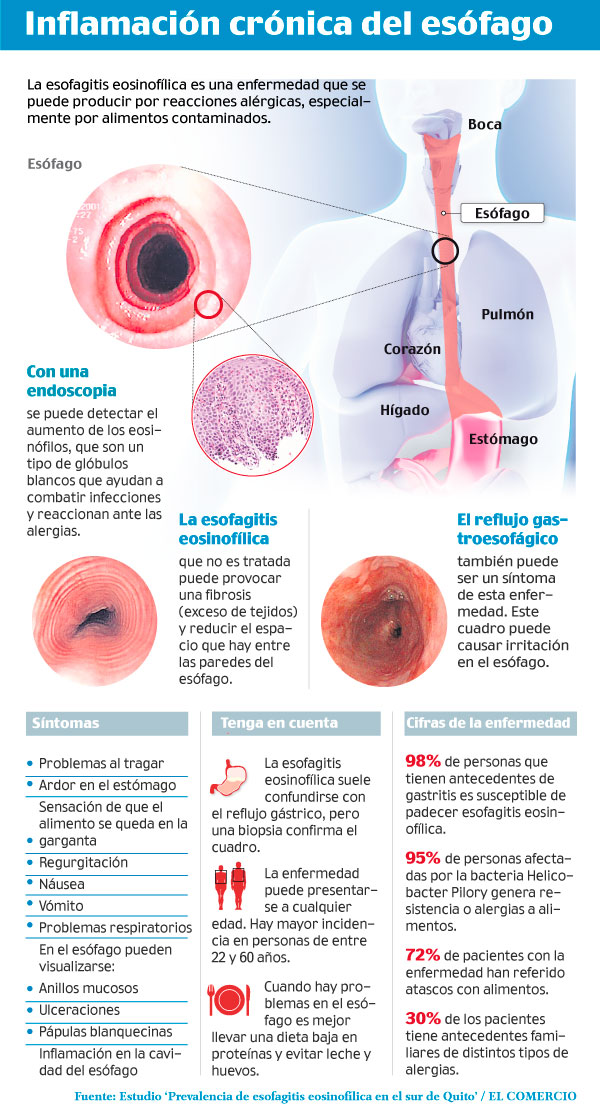 Inflamacion cronica del esofago.: EL COMERCIO